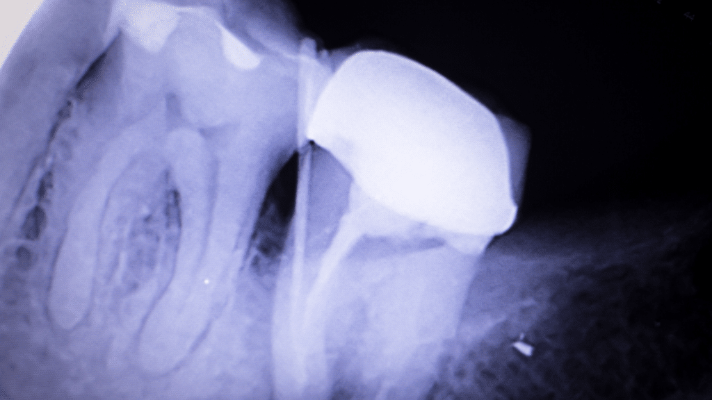 Tooth Abscess X Ray